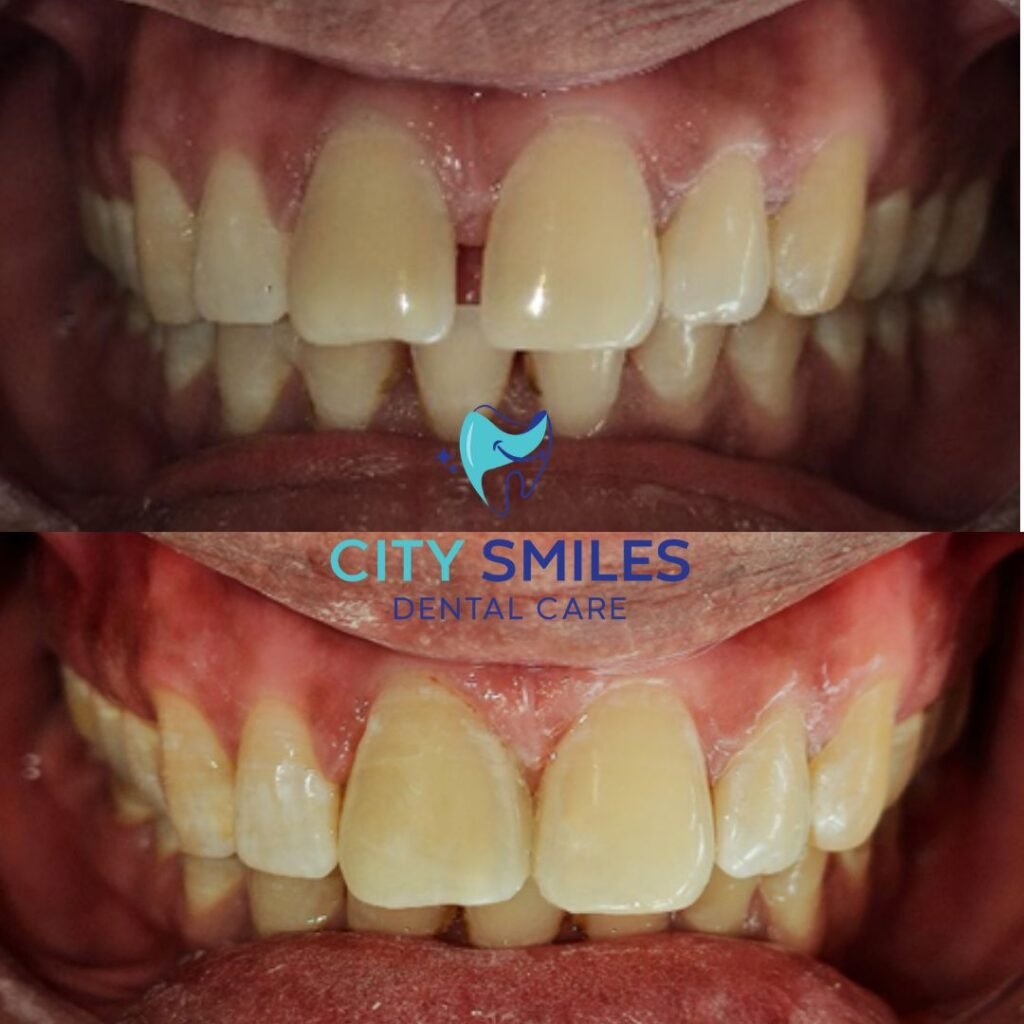 How to Fix the Gap Between Your Front Teeth - City Smiles Dental Care
